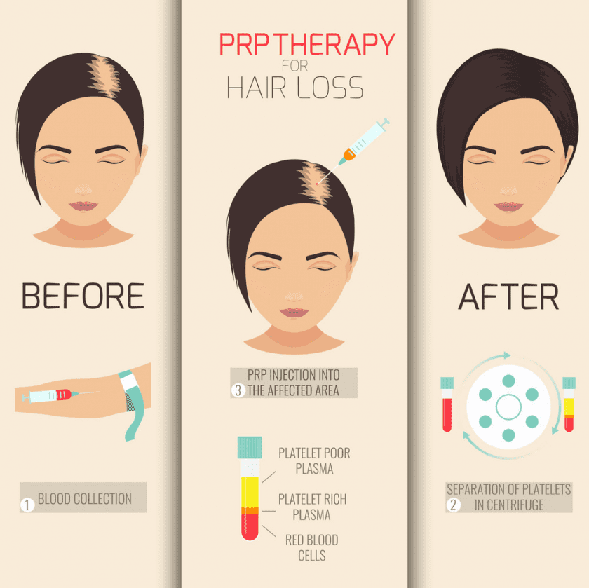 PRP (Platelet Rich Plasma) Hair - MyClinic | Aesthetic Clinic Malaysia