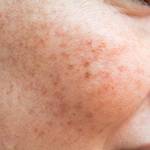 Dual Yellow Laser - MyClinic | Aesthetic Clinic Malaysia