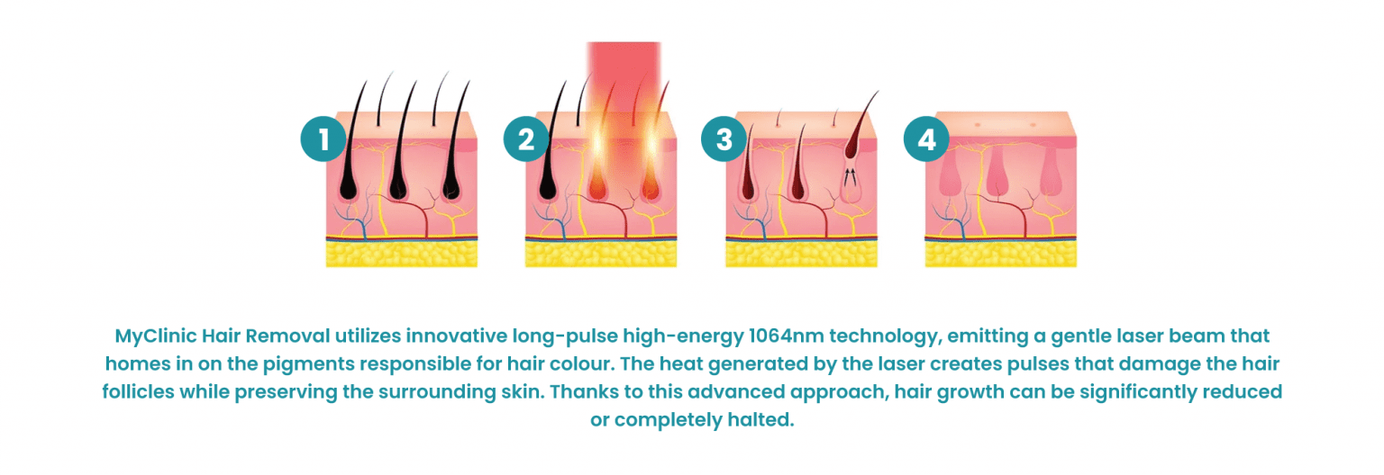 Hair Removal - MyClinic | Aesthetic Clinic Malaysia